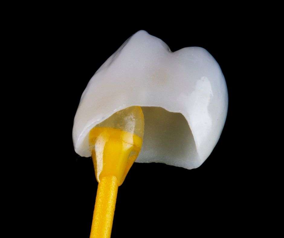 Do I Need a Crown After a Root Canal? - Virginia Endodontics